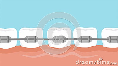 Teeth with Braces Alignment Process. Medically Accurate Animation Stock ...
