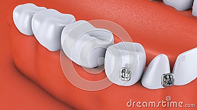Teeth with Braces Alignment Process. Teeth Brace Installing Motion ...