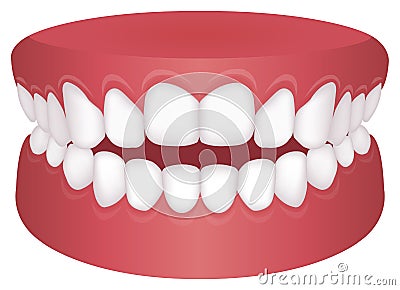Teeth Trouble Bite Type Vector Illustration /Open Bite | CartoonDealer ...