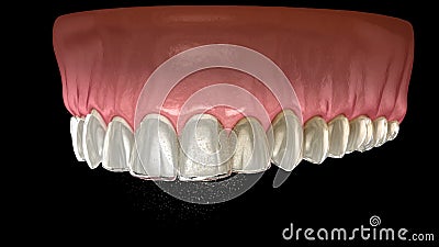 Teeth Whitening with Invisalign Braces or Invisible Retainer. 3D ...