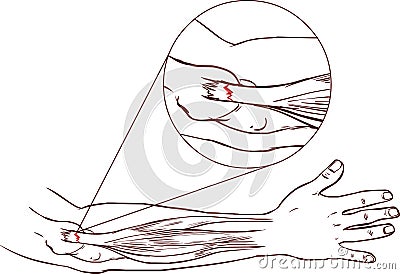 Tennis Elbow - Tear In The Common Extensor Tendon Of The Arm Vector ...