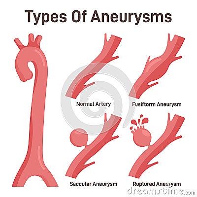 Thoracoabdominal Aortic Aneurysms Types. Healthy Aorta And Aorta Vector ...
