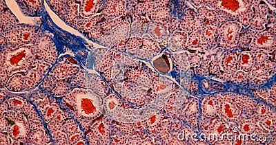 Thyroid gland with colloid stock footage. Video of colloid - 204492678