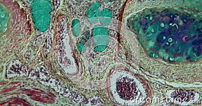 Tissue Diseased with Asthma Stock Video - Video of health, medic: 196228933