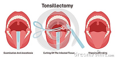Tonsillectomy. Acute Pharyngitis Treatment, Surgical Removal Of The ...