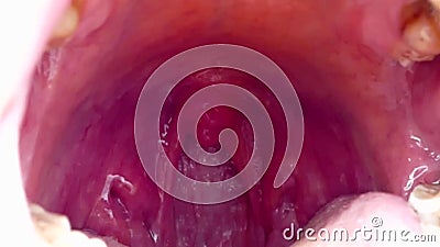 Tonsils Deformed, Tonsillitis, Neglected Poor Human Mouth Interior, a ...