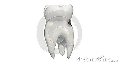 Stages of Tooth Decay or Dental Caries Stock Footage - Video of flat ...