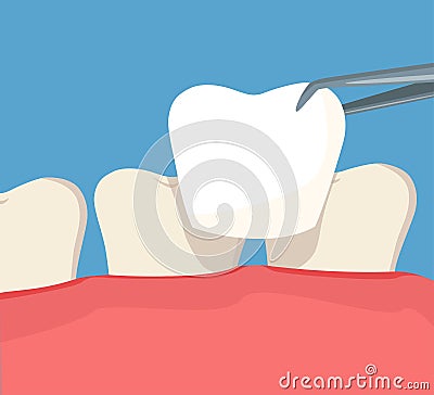 Tooth Restoration. Installing A New Veneer On A Discolored Tooth ...