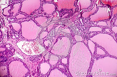 Toxic Diffuse Goiter, Or Graves' Disease, Light Micrograph Stock ...