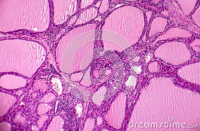 Toxic Diffuse Goiter, Or Graves' Disease, Light Micrograph Royalty-Free ...