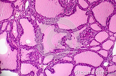 Toxic Diffuse Goiter, Or Graves' Disease, Light Micrograph Stock Photo ...