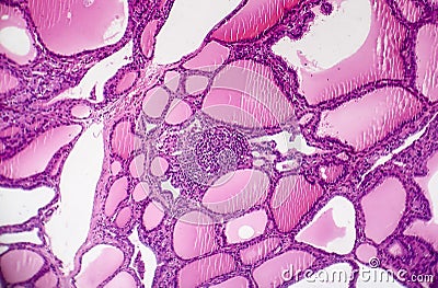 Toxic Diffuse Goiter, Or Graves' Disease, Light Micrograph Stock ...