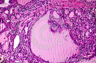 Toxic Diffuse Goiter, Or Graves' Disease, Light Micrograph Royalty-Free ...