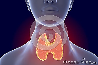 Toxic Diffuse Goiter, Hyperthyroidism Royalty-Free Illustration ...