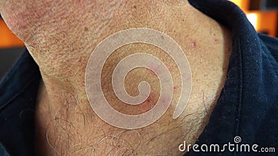 Traces of Insect Bites on the Neck Stock Footage - Video of injury ...