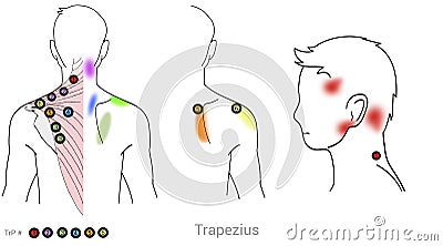 Trapezius Muscle: Managing Pain Arriving From Myofascial Trigger Points ...