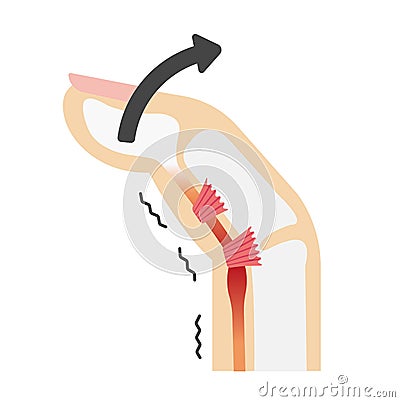 Trigger Finger Causes And Symptoms Illustration | CartoonDealer.com ...