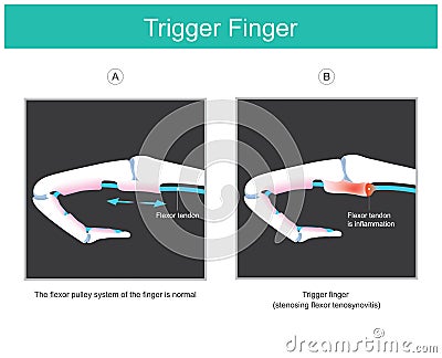 Trigger Finger. Illustration Explain A Symptom Of Locked Finger Caused ...