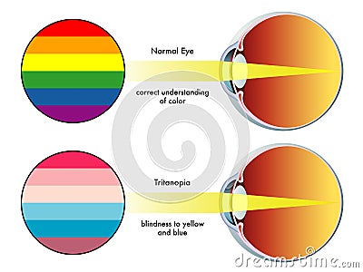 Tritanopia Stock Image - Image: 27568141