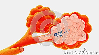 Tuberculosis into the Lungs Stock Video - Video of education, life ...