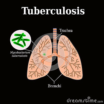 Tuberculosis. Lung Disease. Tubercle Bacillus. Vector Illustration On A ...
