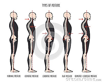 Type Of Posture, Postural Syndromes Infographic. Skeletal Samples Of ...
