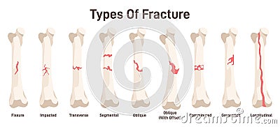 Types Of Bone Fractures. Body Injury, Partial Or Complete Break Vector ...