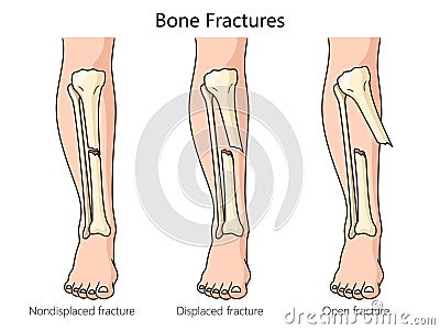 Types Of Bone Fractures Diagram Medical Science Royalty-Free Cartoon ...