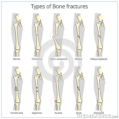 Types Of Bone Fractures Medical Educational Vector | CartoonDealer.com ...