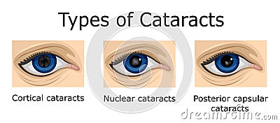 Types Of Cataracts Vector Illustration | CartoonDealer.com #104673500