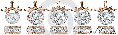 Types Of Lumbar Disc Herniation Royalty-Free Stock Photography ...