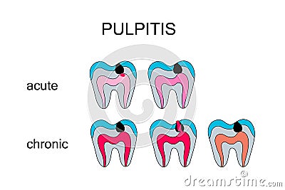 Types Of Pulpitis Hand Drawn Vector Illustration In Cartoon Comic Style ...
