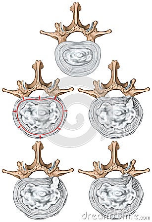 Types And Stages Of Lumbar Disc Herniation Royalty-Free Stock Image ...