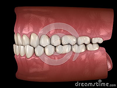 Underbite Dental Occlusion Malocclusion Of Teeth . Medically Accurate ...