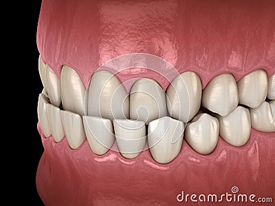 Underbite Dental Occlusion Malocclusion Of Teeth . Medically Accurate ...