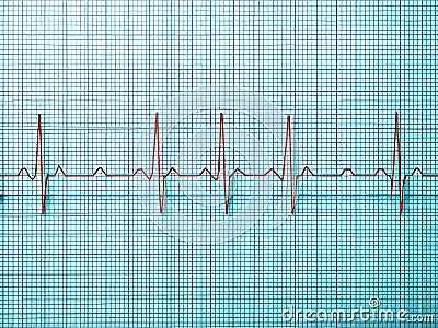 Understanding Single Chamber Atrial Pacemaker ECG Rhythm An 8Second ...