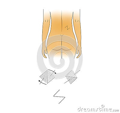 Adjacent Tissue Transfer Or Rearrangement, Trunk Defect 10 Sq Cm Or ...