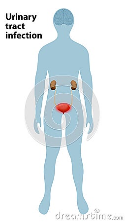 Urinary Tract Infection. Cystitis Cartoon Vector | CartoonDealer.com ...