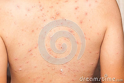 Vaiolo Fotografia Stock - Immagine: 51782206