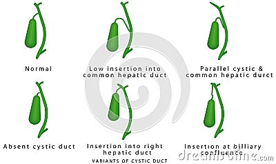 Variants Of Cystic Duct Vector Illustration | CartoonDealer.com #200391716