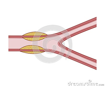 Vasculitis. Destroy Blood Vessels Vector Illustration | CartoonDealer ...