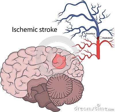 Vector Illustration Of Ischemic Stroke. Brain Infarction ...
