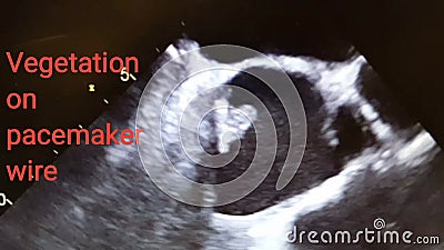 Vegetation on Infected Pacemaker Wire - Endocarditis Patient Stock ...
