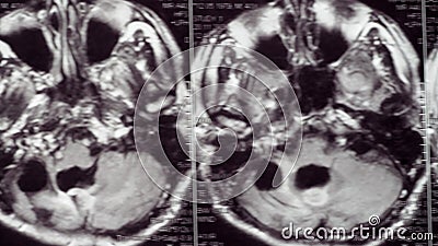Viewing an MRI Image Showing a Defect in the Brain. Close-up. Slider ...