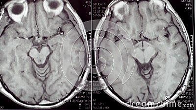 Viewing an MRI Image Showing a Defect in the Brain. Close-up. Slider ...