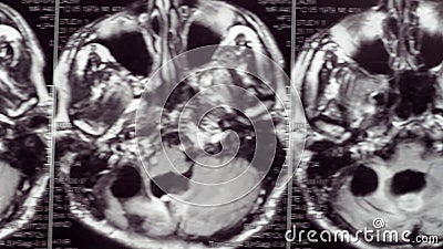 Viewing an MRI Image Showing a Defect in the Brain. Close-up. Slider ...