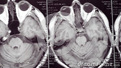 Viewing an MRI Image Showing a Defect in the Brain. Close-up. Slider ...