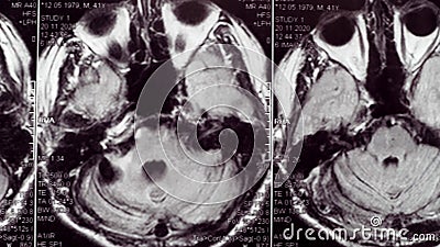 Viewing an MRI Image Showing a Defect in the Brain. Close-up. Slider ...