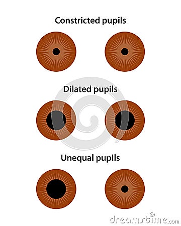 Human Eye. Constricted, Dilated, And Unequal Pupils. Cartoon Vector ...