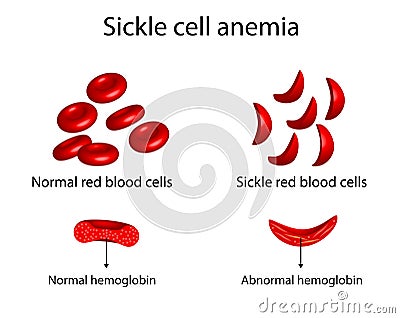 Anemia. Sickle Cell Disease. Cartoon Vector | CartoonDealer.com #258460077